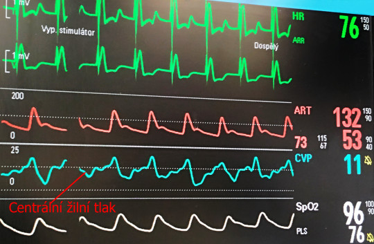 Kompletní monitoring nemocného na JIP II.
